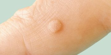 What is Early Stage HPV Warts? | Types of HPV Warts. – informer57.com